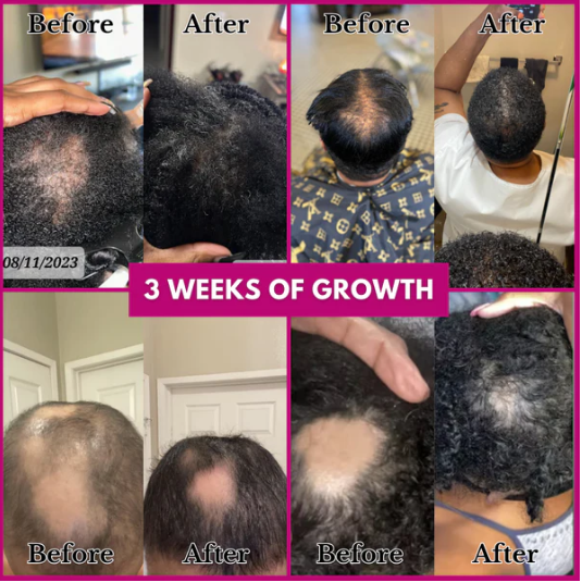 Battling Alopecia with Fenugreek and Rosemary Oil: Your Ultimate Guide ...